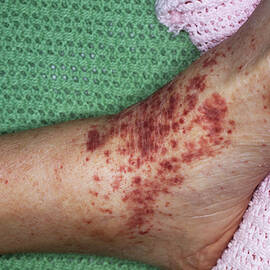 Rashes Art for Sale - Fine Art America