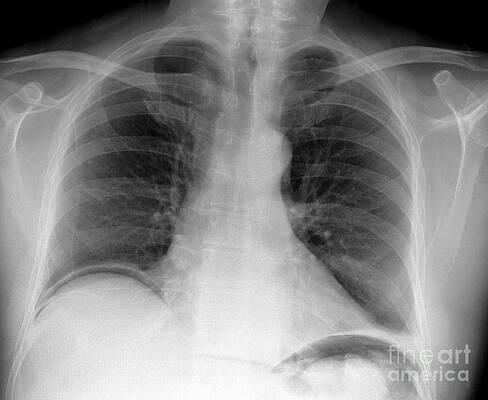 Pneumoperitoneum Art for Sale - Fine Art America