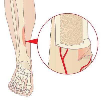 Splints Art - Pixels