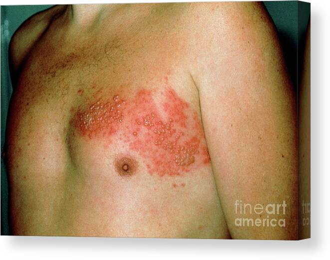 Shingles Rash Chest