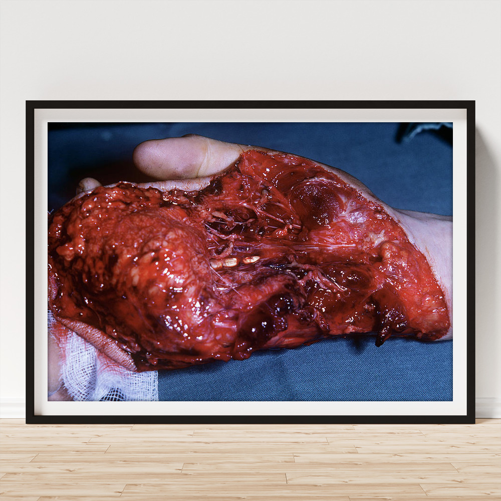 Degloving Injury Poster by Science Photo Library - Science Photo Gallery