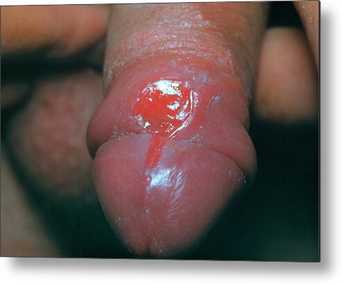 Chancre (sore) On Penis Due To Primary Syphilis Metal Print by Science Photo Library - Science ...